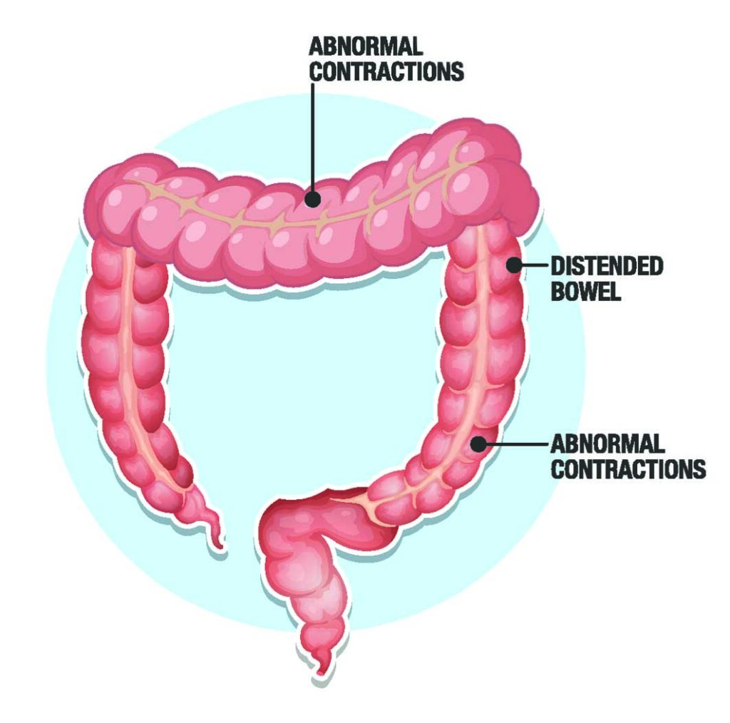 Kesejahteraan Kolorektal tentang Bedah&Pencernaan | Opsi Medis