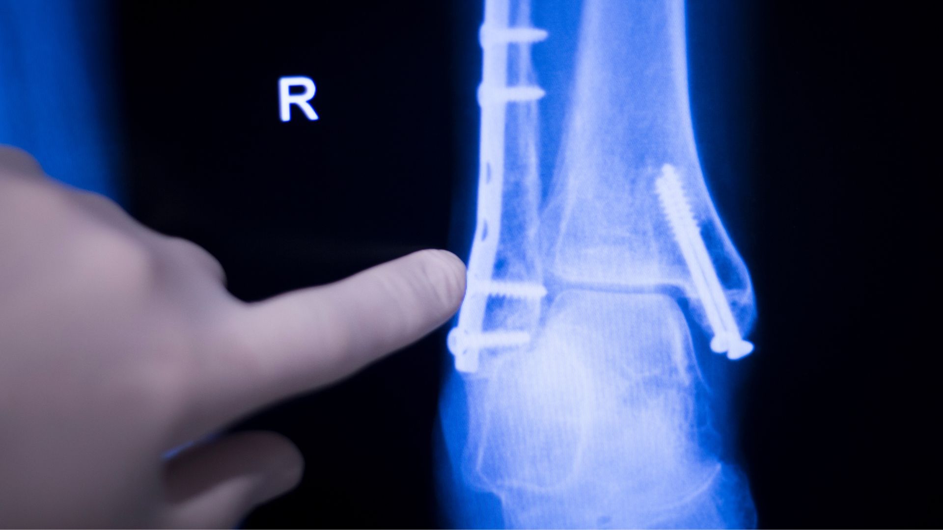 Daftar Spesialis Dokter Ortopedi Kaki & Mata Kaki Di Penang